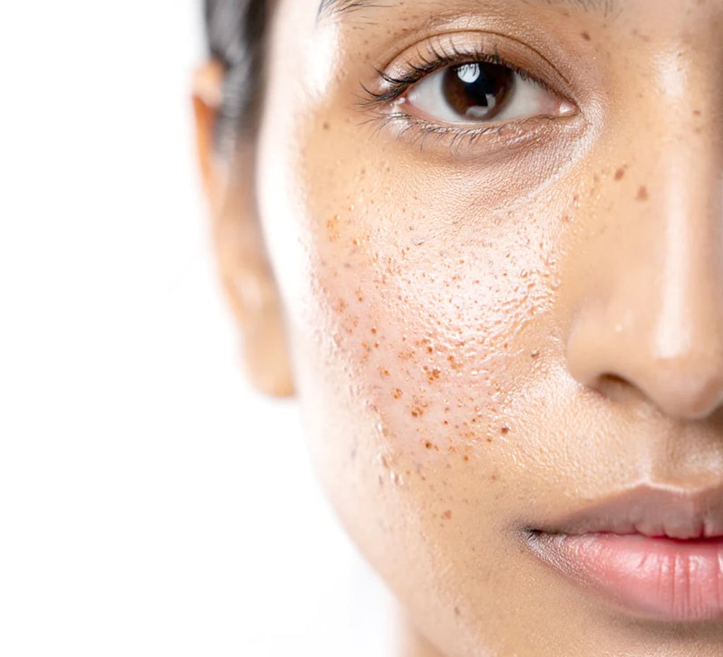 Hyperpigmentation Treatment: What It Is and How to Treat It Effectivel